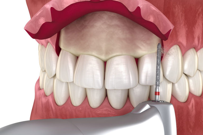 Is A Crown Lengthening Procedure In Bloomfield Hills, MI, Right For Me ...