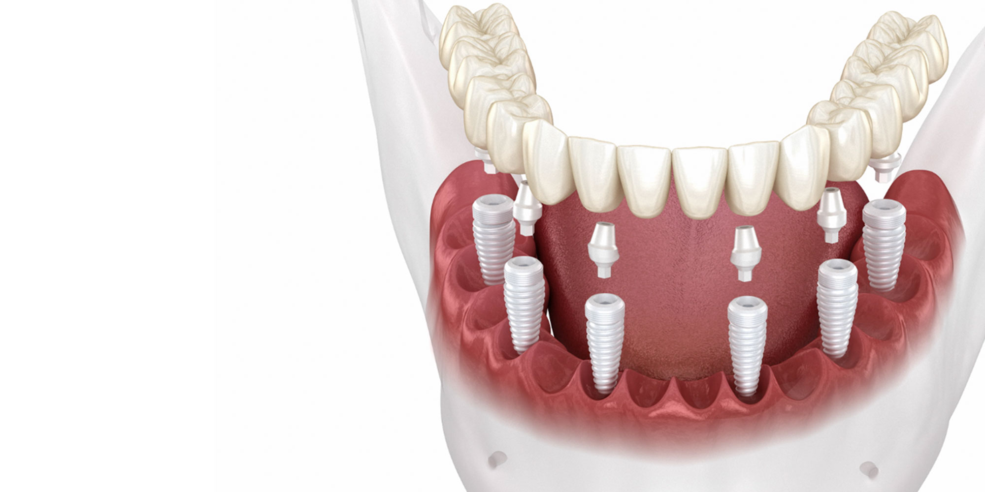 Transform Your Smile with Ceramic Dental Implants and Holistic ...